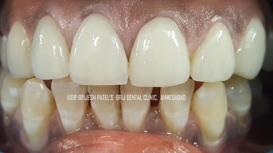 Ceramic Zirconia Tooth Capping Ahmedabad | Ceramic Tooth cap cost in ...
