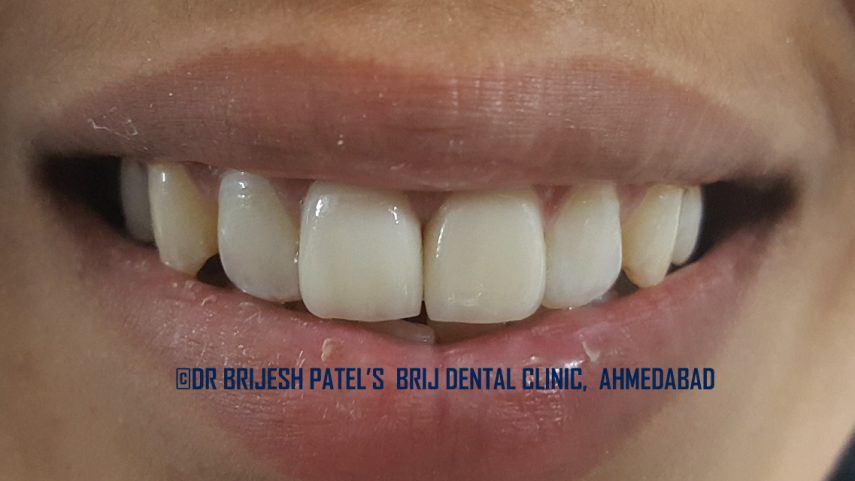 Dental Crown and Bridges Treatment Ahmedabad India| Ceramic Teeth ...