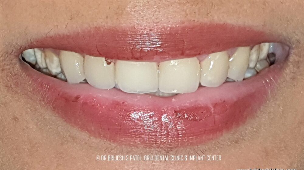 Porcelain Veneer Ahmedabad | Smile Makeover by Emax Ceramic Veneer