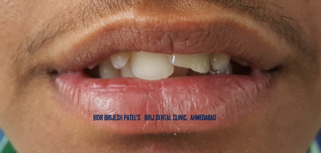 Dental Crown and Bridges Treatment Ahmedabad India| Ceramic Teeth ...