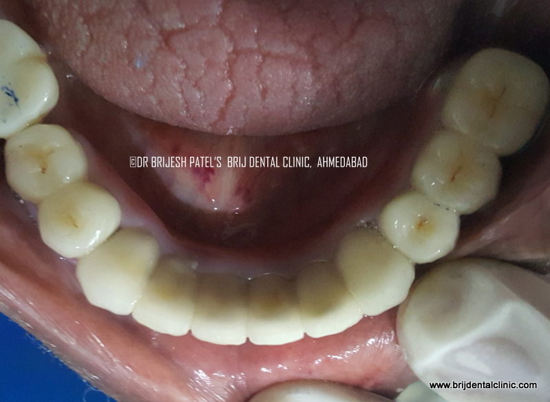 Full Mouth Dental Implant cases in Ahmedabad| Dental Implants before after
