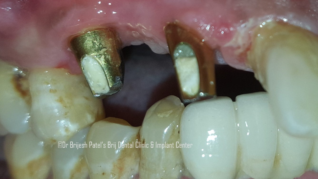 Dental Implants Before And After Pictures