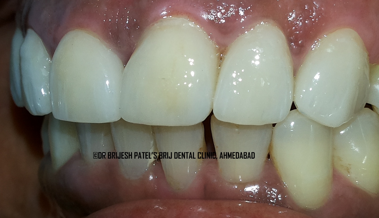 Porcelain Veneer Ahmedabad | Smile Makeover by Emax Ceramic Veneer