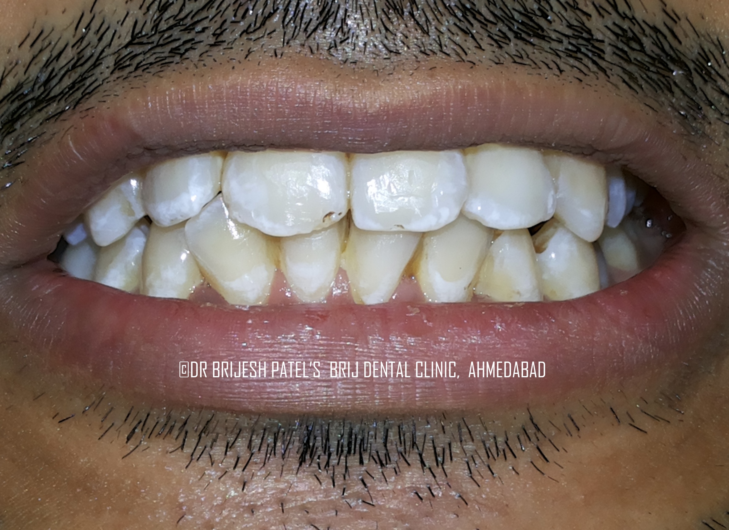 invisible braces canine teeth