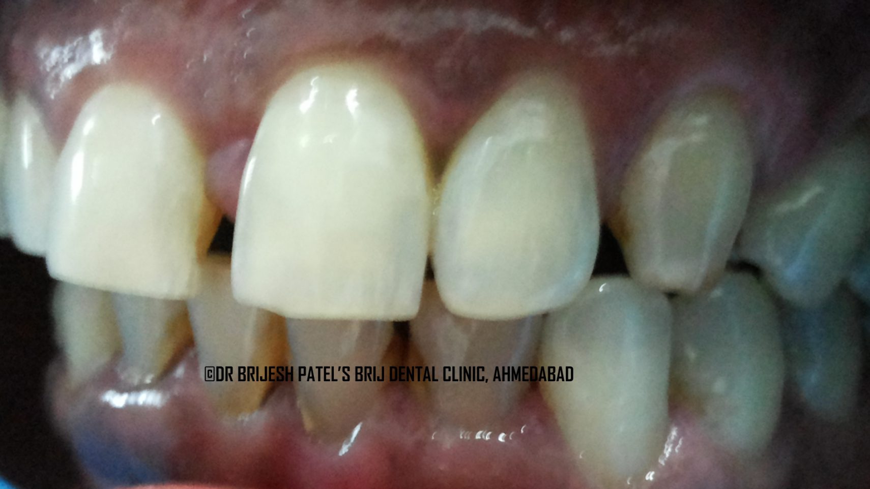 Porcelain Veneer Ahmedabad | Smile Makeover by Emax Ceramic Veneer