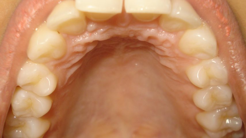 Invisible Braces Cost in Ahmedabad India| Lowcost Clear Invisalign aligner