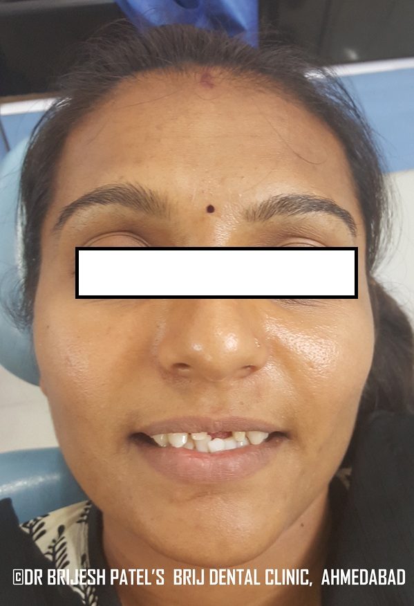 Smile Makeover Cases | Brij Dental Clinic