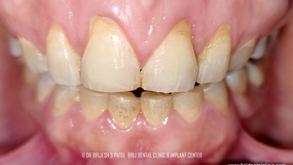 Painless Laser Gum Surgery Ahmedabad - No cut, No Bleed, No stitch