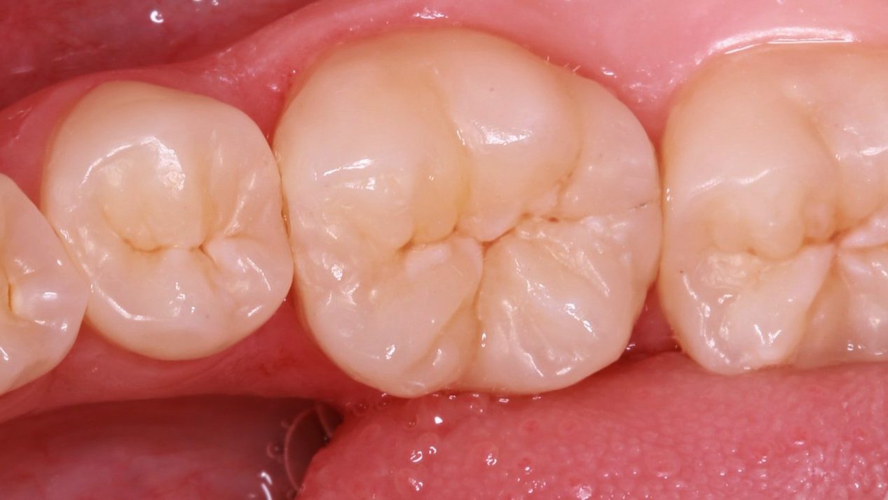 Tooth Filling Cost in Ahmedabad | Dental Cavity treatment in Ahmedabad