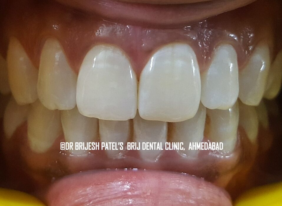 Invisible Braces Cost in Ahmedabad India| Lowcost Clear Invisalign aligner