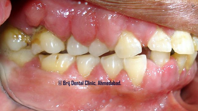 Painless Laser Gum Surgery Ahmedabad - No cut, No Bleed, No stitch