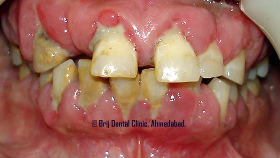 Painless Laser Gum Surgery Ahmedabad - No cut, No Bleed, No stitch