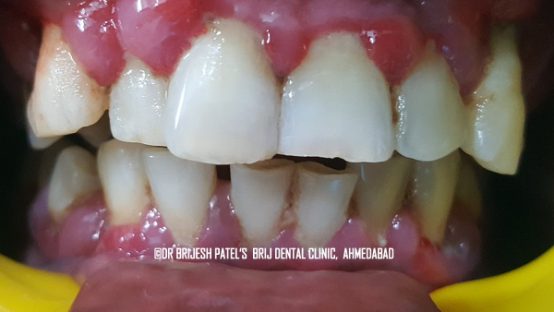 Painless Laser Gum Surgery Ahmedabad - No cut, No Bleed, No stitch