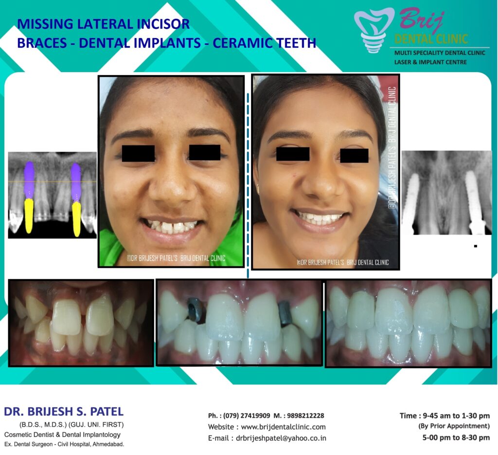 IMPLANT FOR MISSING LATERAL INCISOR- BRACES - IMPLANT- CERAMIC TEETH ...