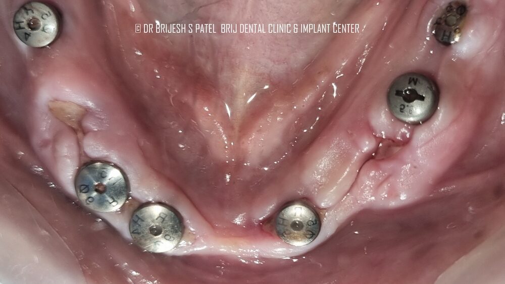 Dental Implant Single Arch Cases | Brij Dental Clinic