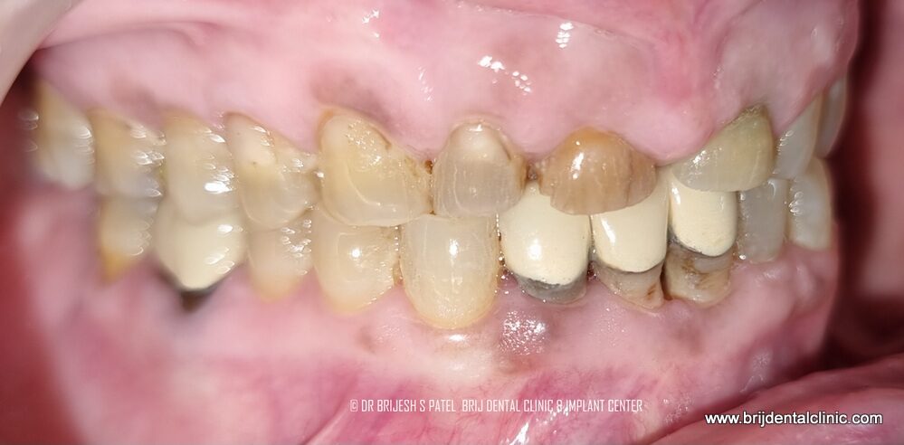 Full Mouth Rehabilitation & Reconstruction Before and after Photos