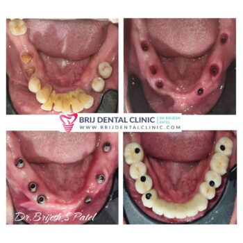 Full mouth Dental Implants in Ahmedabad India | Best Implant Dentist