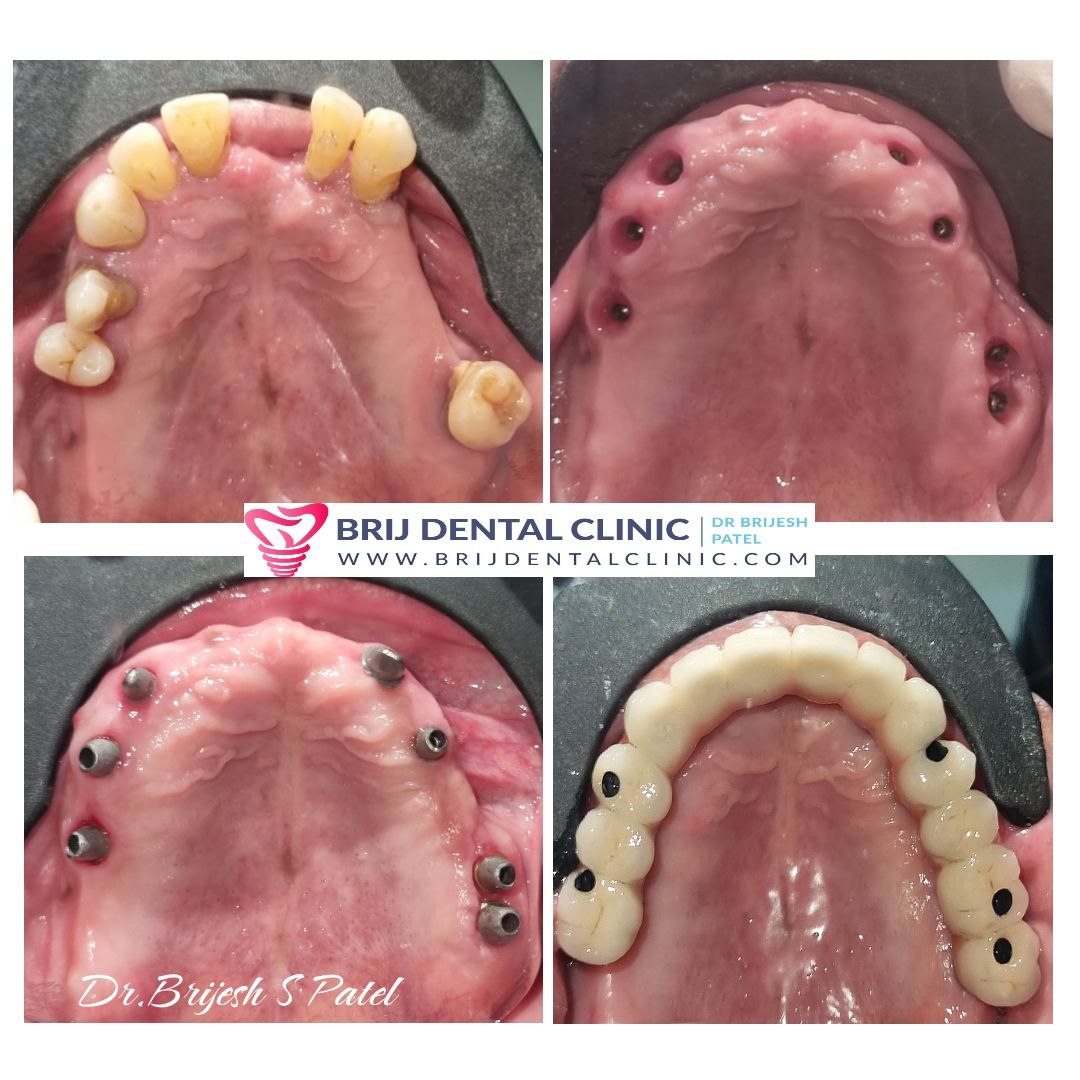 Best Implant Dentist Ahmedabad | Full mouth Dental Implants India