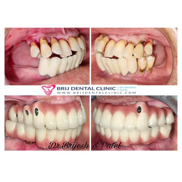 Best Implant Dentist Ahmedabad |Full mouth Dental Implants india
