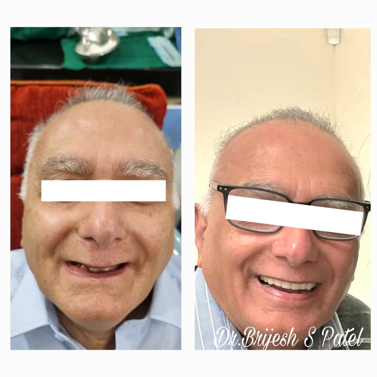 Best Implant Dentist Ahmedabad | Full mouth Dental Implants India