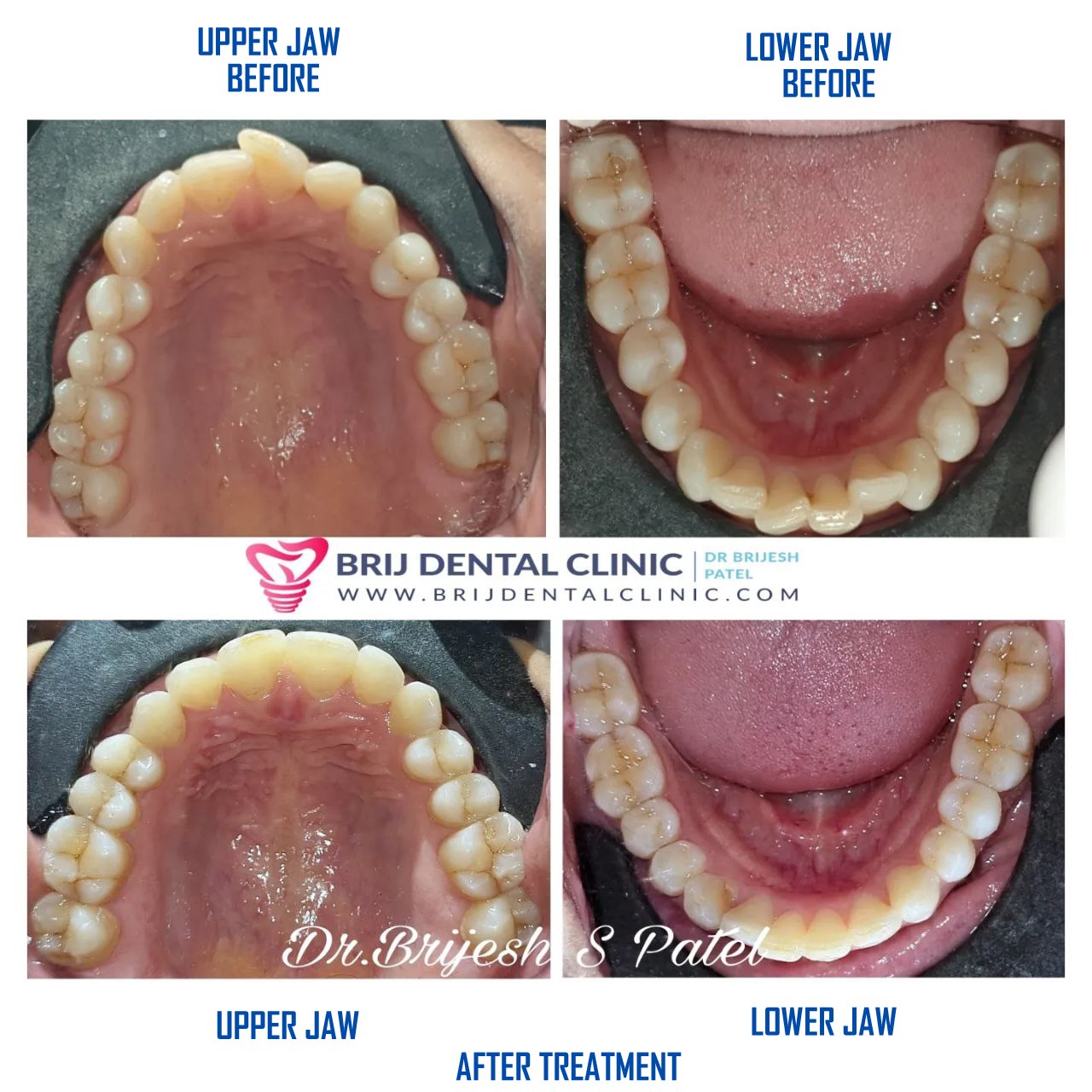 Invisible Clear Aligners (No Braces) Cost in Ahmedabad India | Lowcost ...
